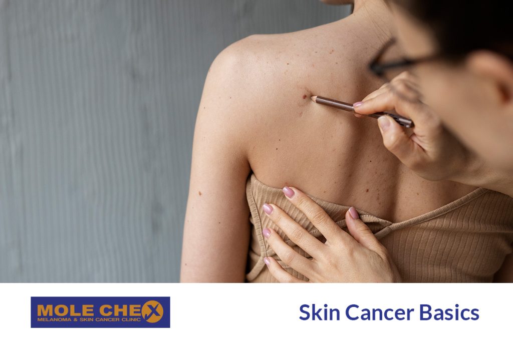 Skin Cancer Basics: Types, Symptoms, and Early Detection - MoleChex - Skin Cancer and Melanoma ...