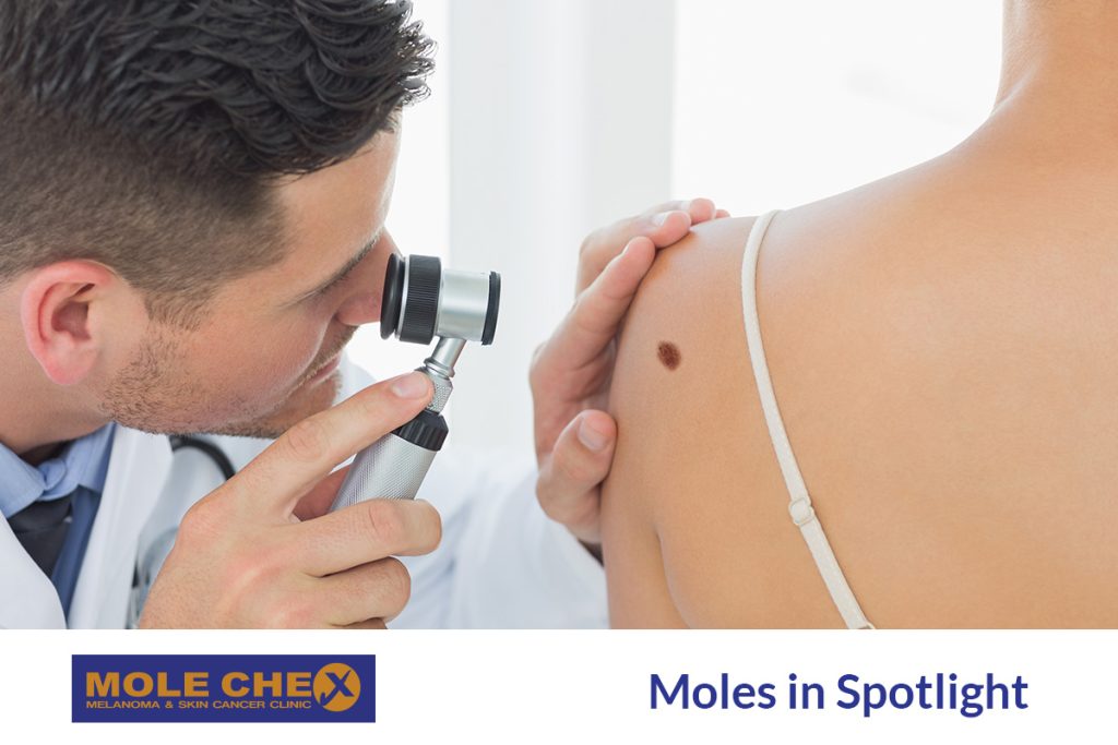 Moles in Spotlight : What's Normal and What's Not - MoleChex - Skin Cancer and Melanoma Clinic