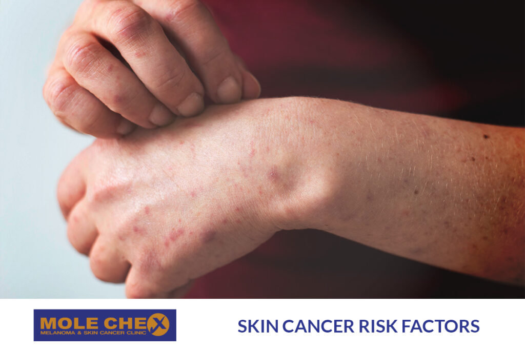 Skin Cancer Risk Factors: Know Your Vulnerabilities - MoleChex - Skin ...