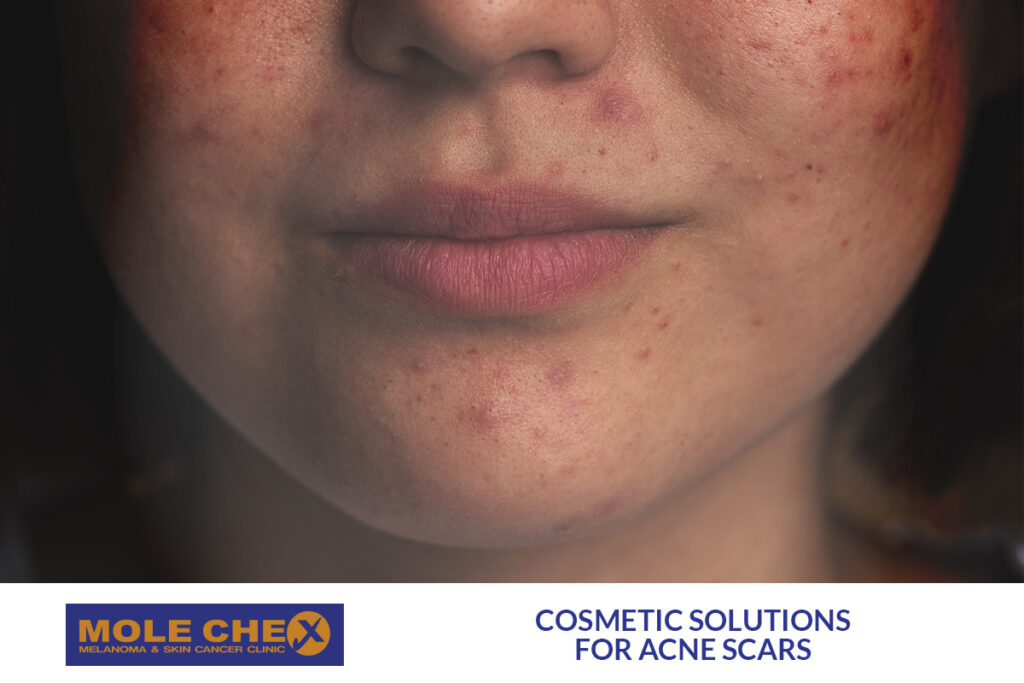 Cosmetic Solutions for Acne Scars: A Path to Clear Skin - MoleChex ...