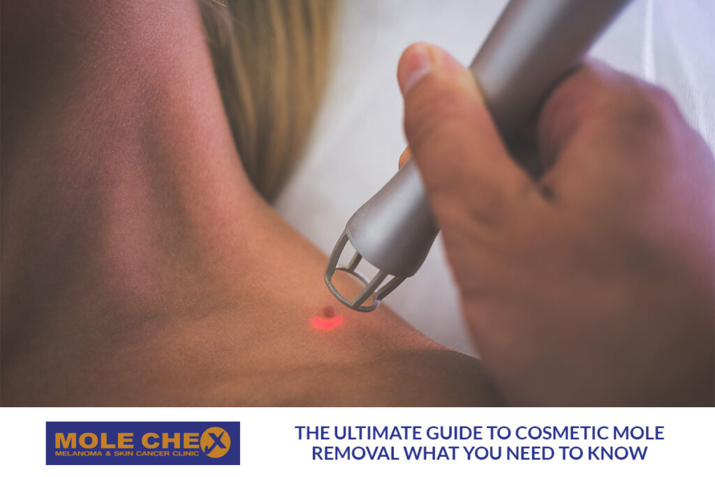 The Ultimate Guide to Cosmetic Mole Removal: What You Need to Know - MoleChex - Skin Cancer and ...