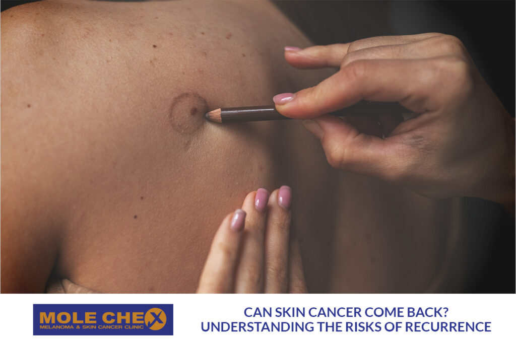 Can Skin Cancer Come Back? Understanding the Risks of Recurrence - MoleChex - Skin Cancer and ...