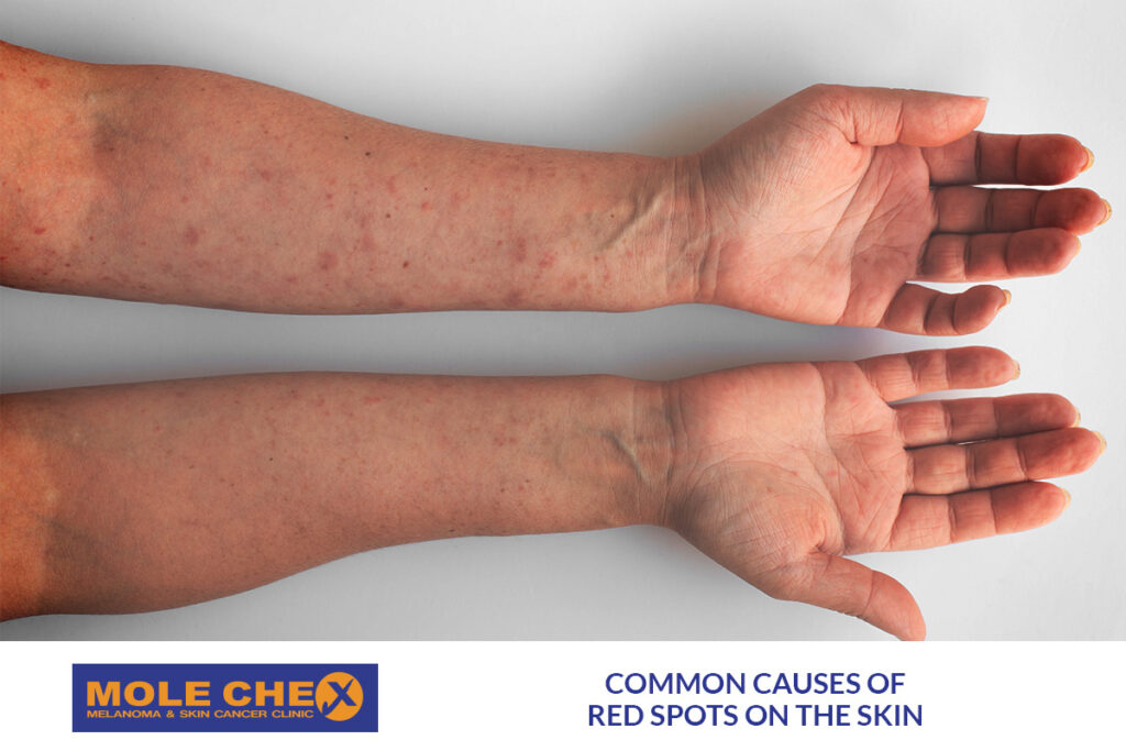 Understanding Red Spots on Skin - MoleChex - Skin Cancer and Melanoma ...