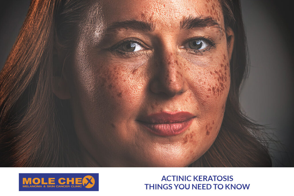 Actinic Keratosis: Know About This Common Skin Warning Sign - MoleChex ...
