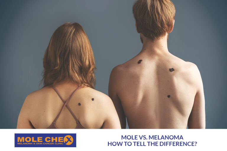 Mole vs. Melanoma: How to Tell the Difference - MoleChex - Skin Cancer and Melanoma Clinic
