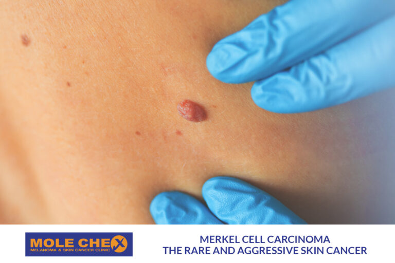 Merkel Cell Carcinoma: The Rare and Aggressive Skin Cancer - MoleChex ...
