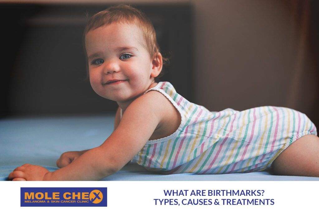 What Are Birthmarks? Types, Causes & Treatments - MoleChex - Skin ...