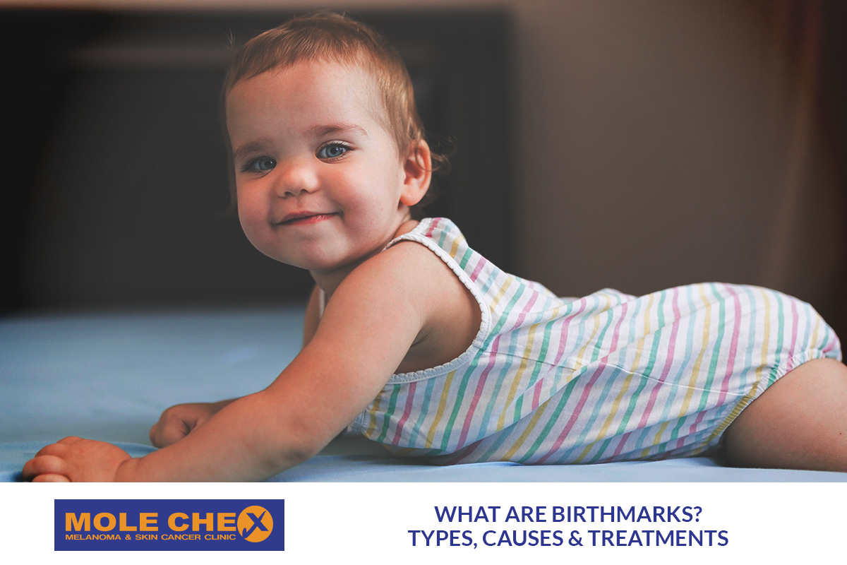 What Are Birthmarks? Types, Causes & Treatments - MoleChex - Skin Cancer and Melanoma Clinic