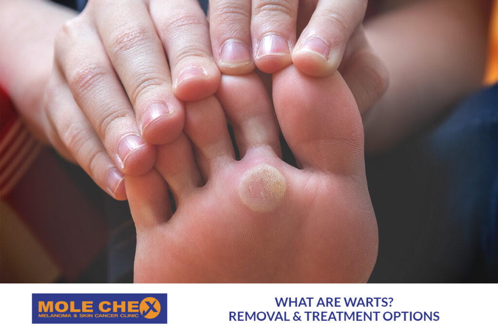 What are Warts? Removal and Treatment options - MoleChex - Skin Cancer ...