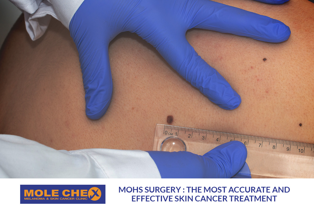 Mohs Surgery : The Most Accurate and Effective Treatment - MoleChex - Skin Cancer and Melanoma ...