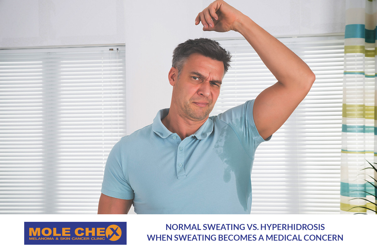 Sweating vs. Hyperhidrosis: When Sweating Becomes a Concern - MoleChex ...