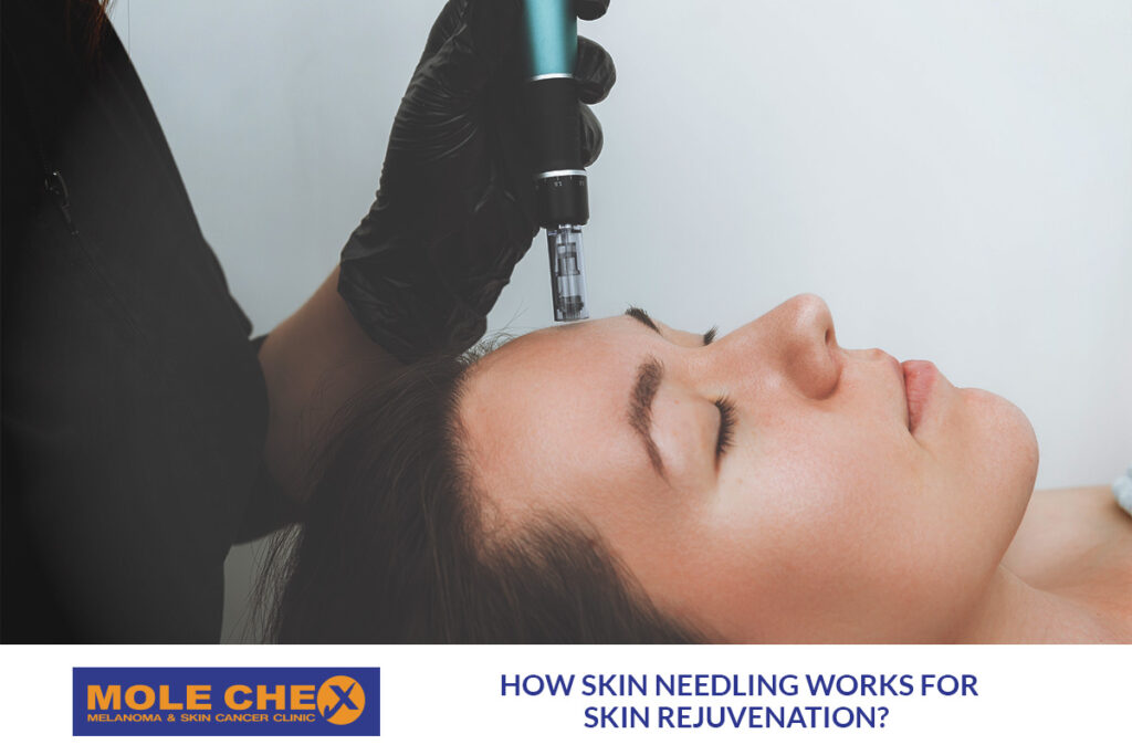 What Is Skin Needling? How Needling Treatment Works - MoleChex - Skin ...