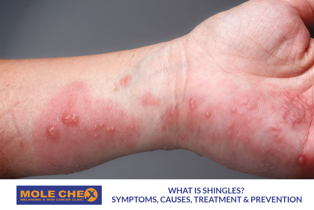 What Is Shingles? Symptoms, Causes, Treatment and Prevention - MoleChex ...